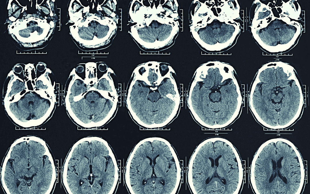 How is Traumatic Brain Injury Diagnosed? - Harding Mazzotti, LLP